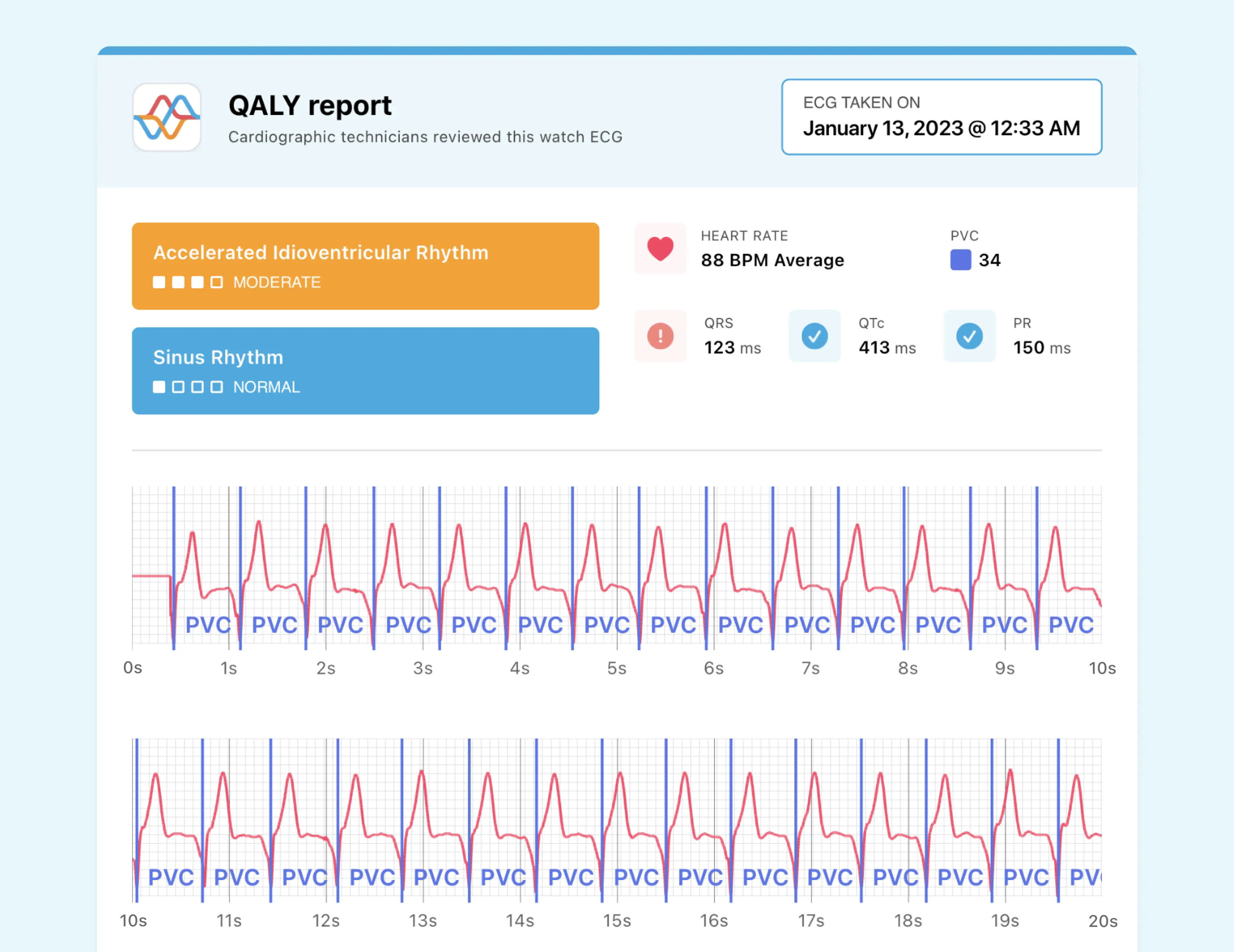What Accelerated Idioventricular Rhythm Looks Like on Your Watch ECG | Qaly